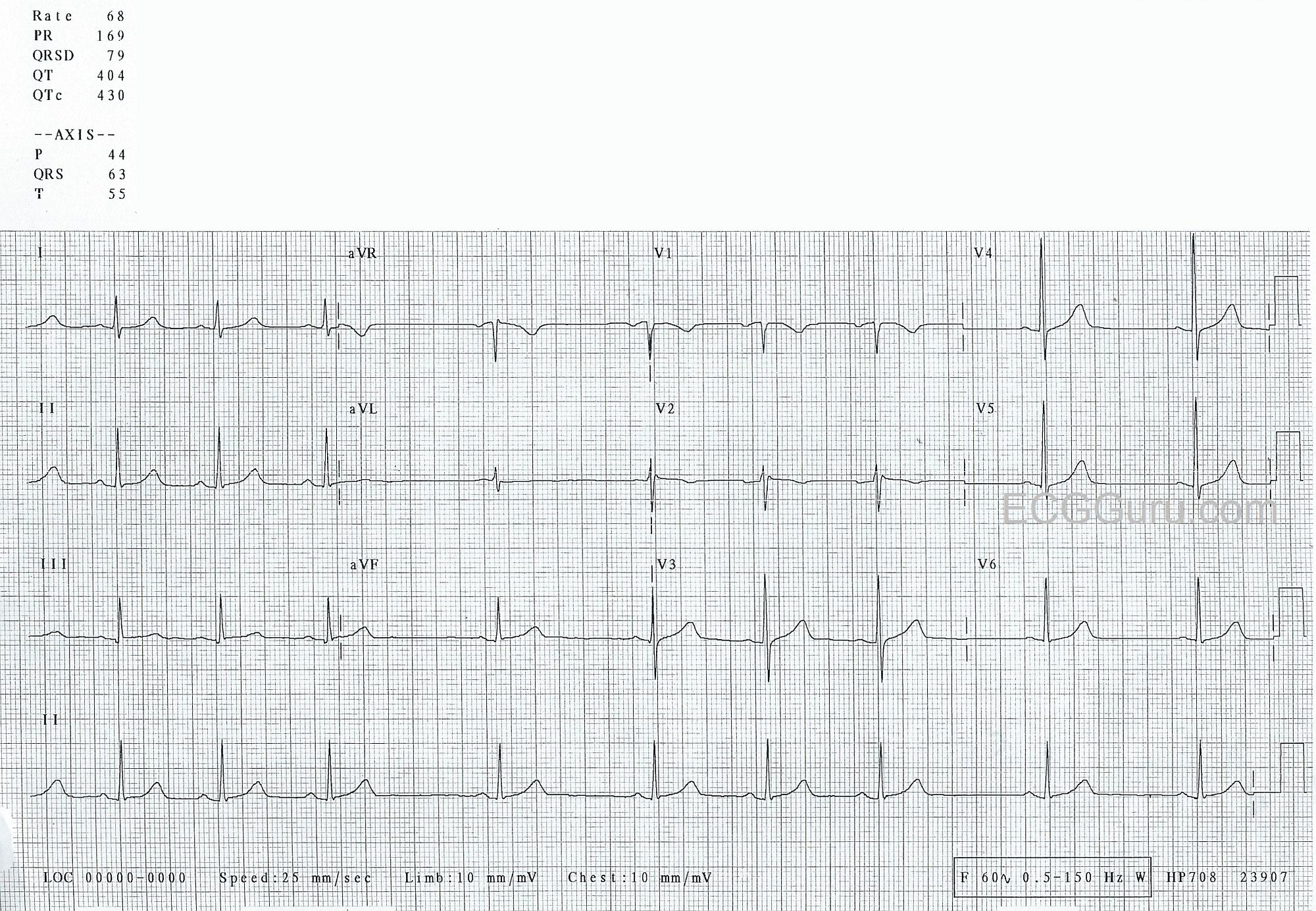 Irregular Rhythm In A Young Person Ecg Guru Instructor Resources